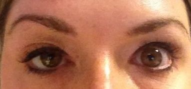 Botox Injections Treatment Blepharospasm, Hemifacial Spasm, Meiges ...