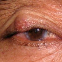 Sebaceous Cell Carcinoma Treatment in Mumbai & India, Flap Surgery ...