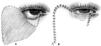 Plastic & Reconstructive Eyelid Surgery | Oculoplastic Eyelid Orbit ...